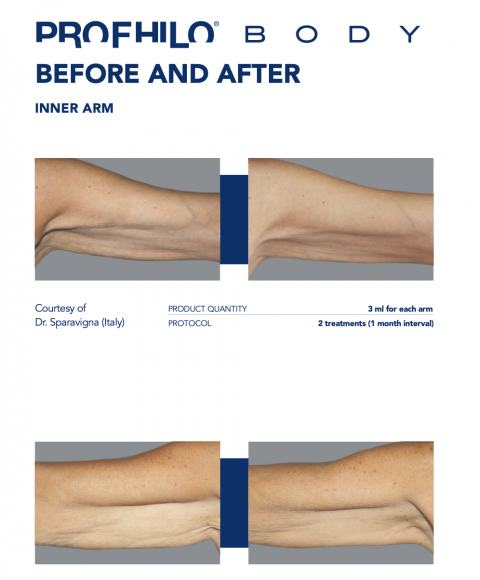 Profhilo Body - Anti-Ageing Treatments in Herefordshire